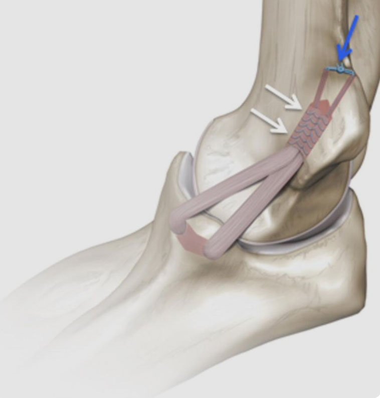 Elbow Ligament Repair | Treatment for Instability & Sports Injuries