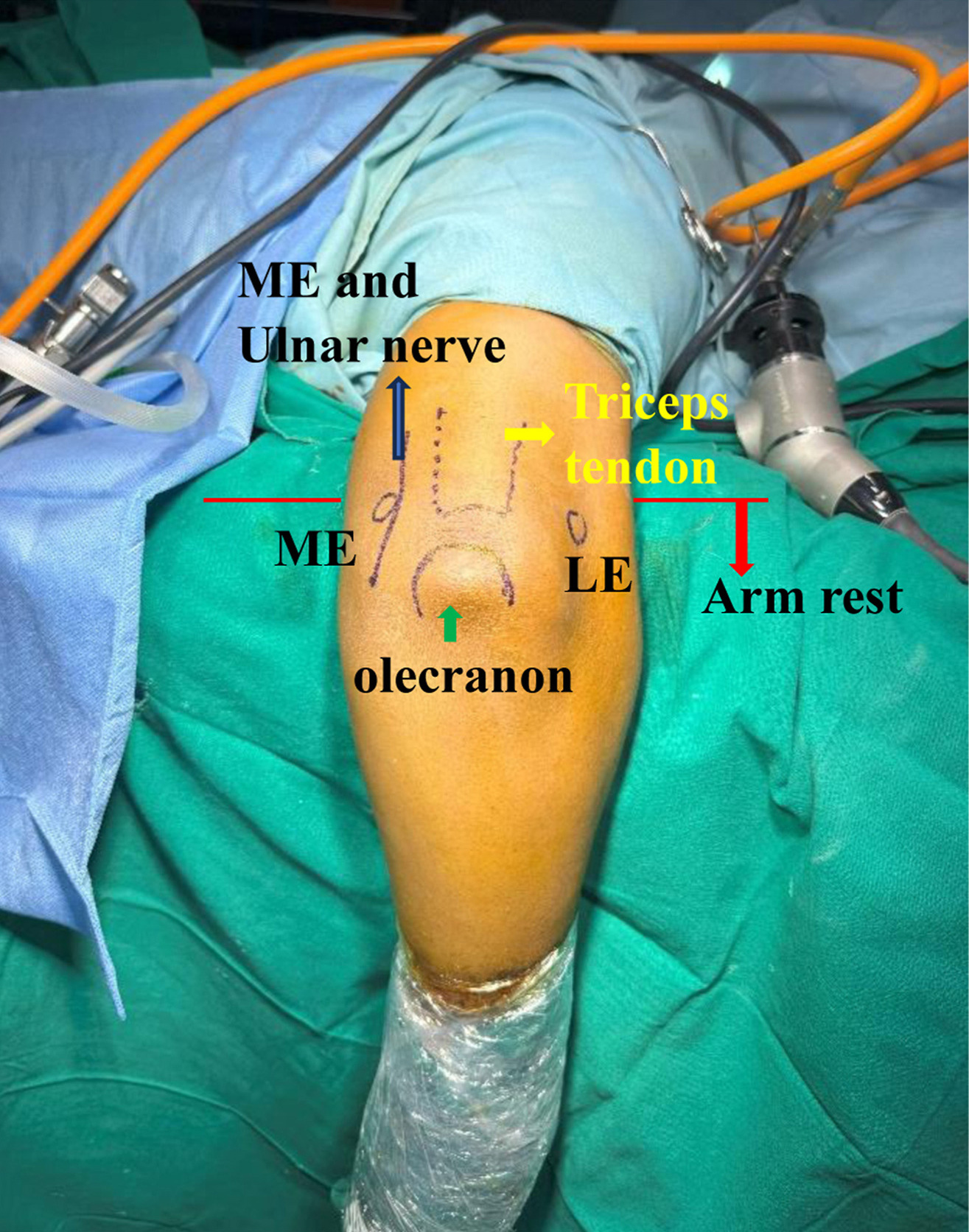 Triceps Tendon Repair | Surgical Treatment for Elbow Tendon Ruptures